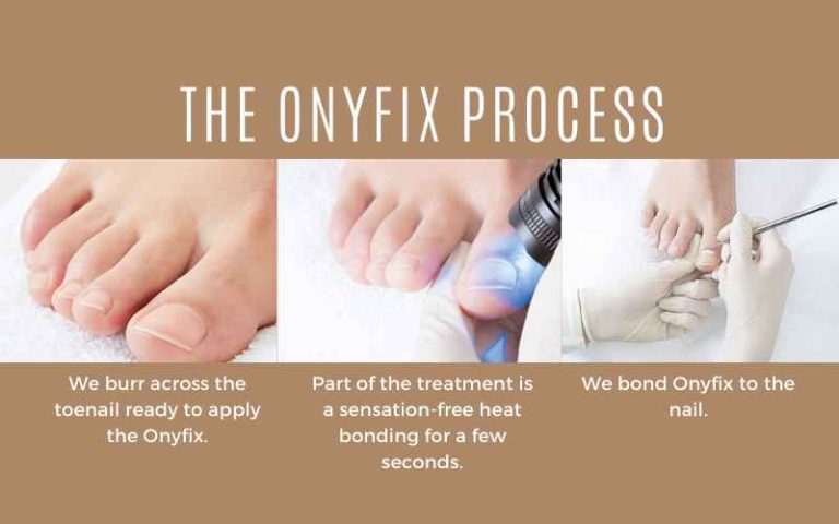 Onyfix Nail Correction Canberra | Capital Podiatry